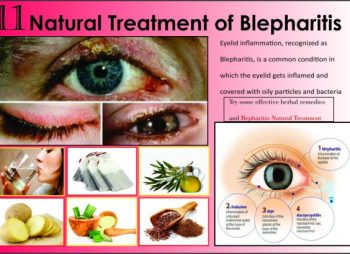 Blepharitis - Herbal Care Products - Blog