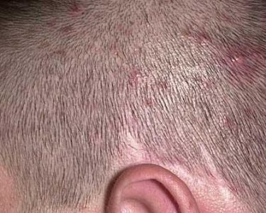 Folliculitis - Hot Tub Rash And Inflammation - Herbal Care Products - Blog