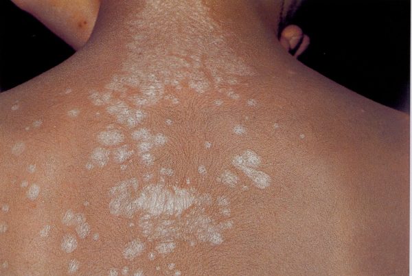 Coconut Oil for Lichen Sclerosus Natural Treatment - Herbal Care ...