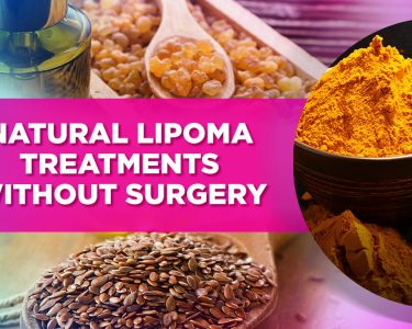 10 Natural Home Remedies for Lipoma - Herbal Care Products - Blog