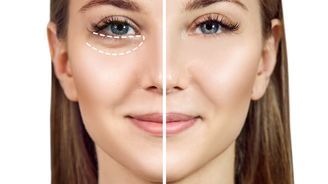 How to Get Rid of Eye Bags Permanently at Home: Your Complete Step-by ...