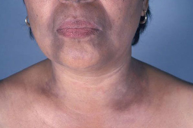 Living with Lichen Planus Pigmentosus: Expert Tips for Skin Care ...
