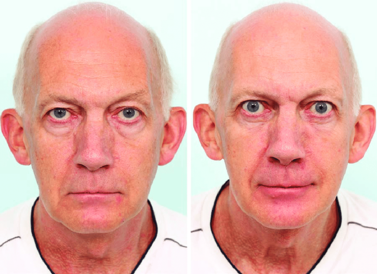 Men’s Eye Bags Treatment: Top Eye Bag Remedies for Men - Herbal Care ...