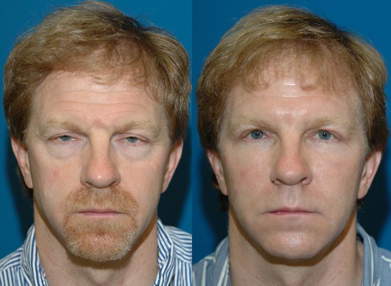 Men’s Eye Bags Treatment: Top Eye Bag Remedies for Men - Herbal Care ...