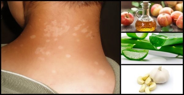 5 Remedies for Tinea Versicolor You Can Do at Home - Herbal Care Products
