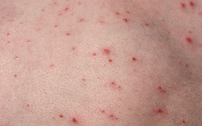 How do you get rid of long term Folliculitis?