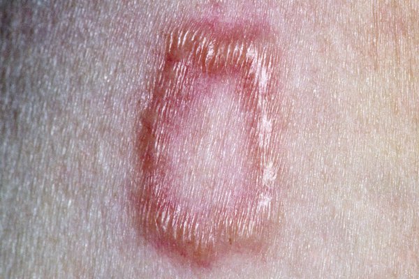 Granuloma Annulare vs Ringworm: Symptoms, Treatments and More - Herbal ...
