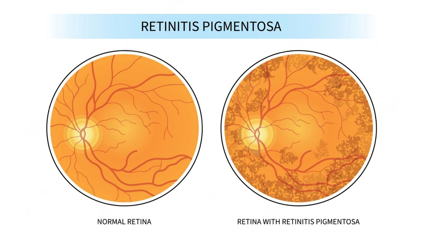 Different Types of Retinitis Pigmentosa and What They Mean for Your ...